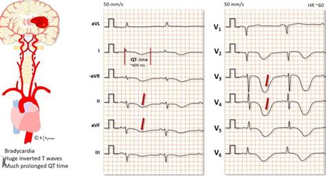Neurologic Insult And Ecg Finding The Incidence Of Electrocardiogram