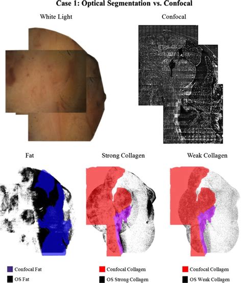Comparing The Optical Segmentation Of The Training Case To The Confocal
