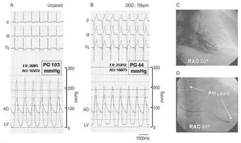 Simultaneous Recordings Of The Left Ventricular And Aortic Pressures