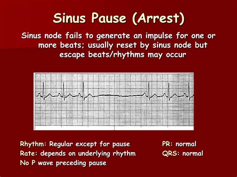 Ppt Basic Ecg Powerpoint Presentation Free Download Id 4748985