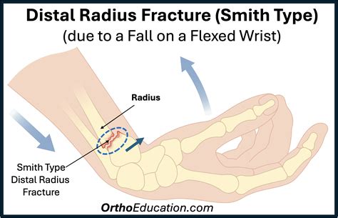Distal Radius Fractures Hand Education