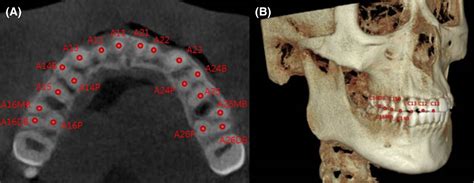 Figure 1 From Morphometric Analysis Of The Maxillary Root Apex