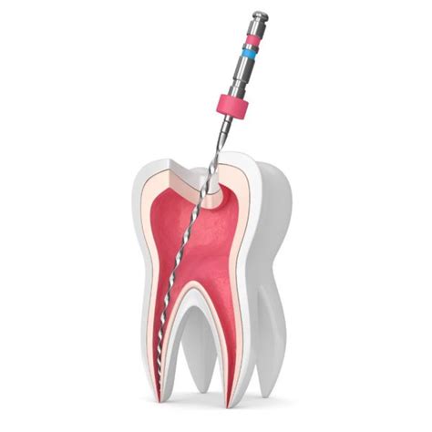 Endodontie Endoclinic