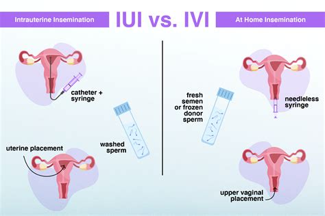 Iui Process At Home Julia Cameron