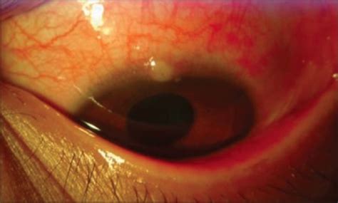 Danielle Beleho On Linkedin Phlyctenular Conjunctivitis Tuberculosis