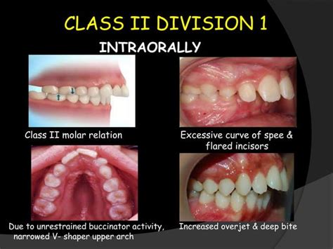 Angles Class Ii Malocclusion