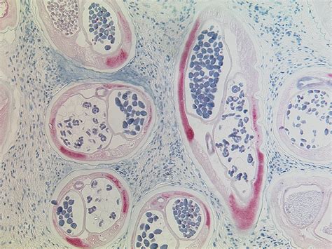 Artificial Intelligence In The Fight Against River Blindness