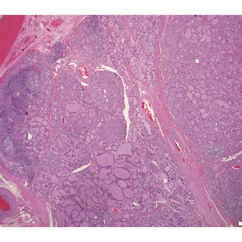 Patient Photograph Showing Diffusely Enlarged Thyroid Gland Left Profile Download