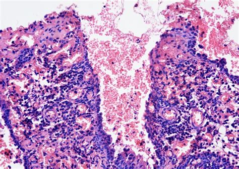 Deep Epithelial Erosion Associated With Micro Hemorrhages Within The