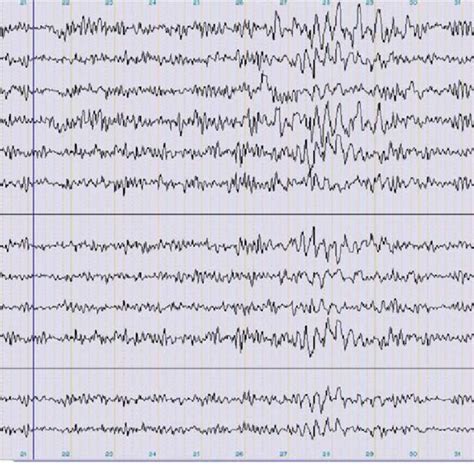 Ictal Eeg Showing Rhythmic Spike And Polyspike And Wave Discharges