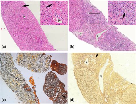 Pathological Characteristics Of Liver Tissue In Patients A Liver Download Scientific Diagram