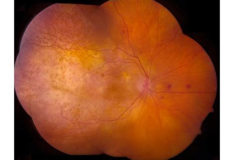 Choroidal Metastasis Wills Eye Hospital