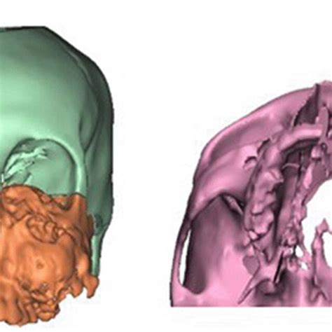 A B Showing 3d Virtual Models Of The Maxillofacial Skeleton With