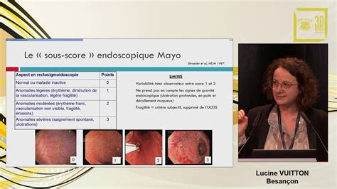 Les Scores Dans La Recto Colite Hémorragique Vidéo Sfed