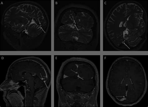 Evaluation Of Giant Arachnoid Granulations With High Resolution 3d