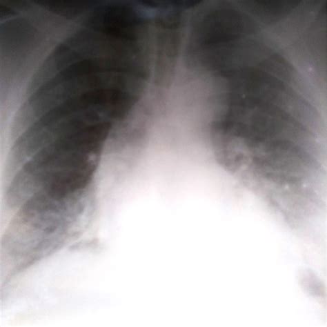 Transthoracic Echo In M Mode Showing Aortic Root Measurement Of 5 48 Cm Download Scientific