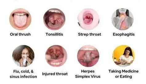 Why Does It Hurt When I Swallow 8 Possible Causes And Remedies Credihealth