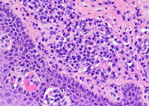 Pathology Outlines Balanitis Phimosis