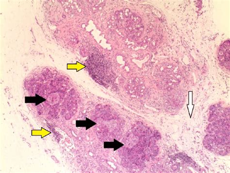 Low Power × 40 Magnification Of The Affected Pancreas There Are