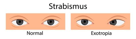 Types Of Strabismus Hypotropia Hypertropia Exotropia Esotropia
