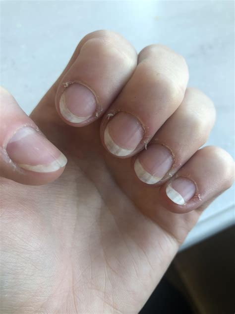 Hangnail Infected Hangnail Causes Treatment And More