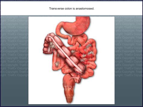 Anastomosed Transverse Colon