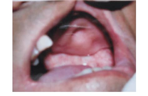 Obturator Prosthesis Inside The Mouth Download Scientific Diagram