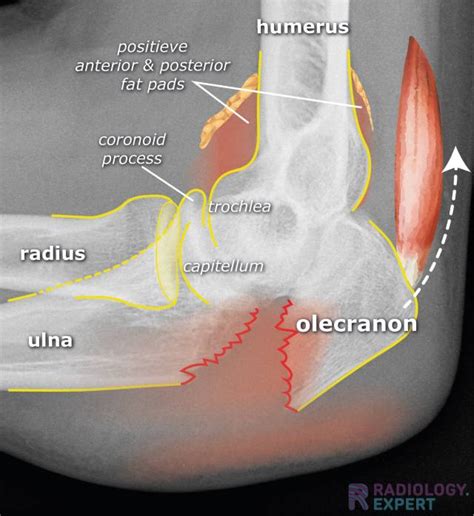 X Elbow
