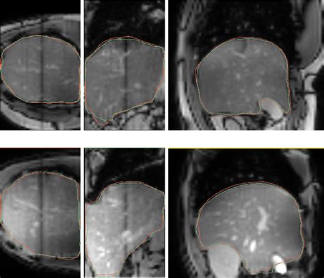 End To End Deformable Attention Graph Neural Network For Single View Liver Mesh Reconstruction