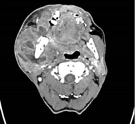 Contrast Enhanced Ct Scan Presenting A Multilocular Abscess Of A