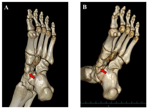 Navicular Bone