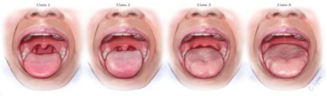 Handp Grading Scales Flashcards Quizlet
