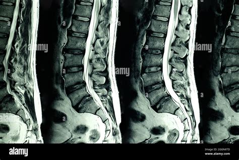 Lumbar Herniation Mri At Valeria Sturm Blog
