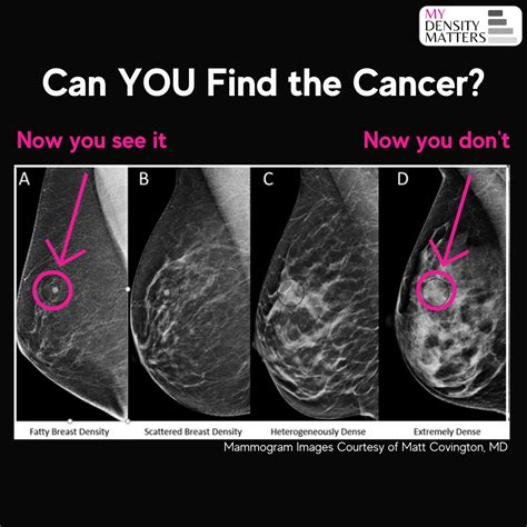 My Density Matters On Linkedin Breastcancer Breastdensity Mammogram