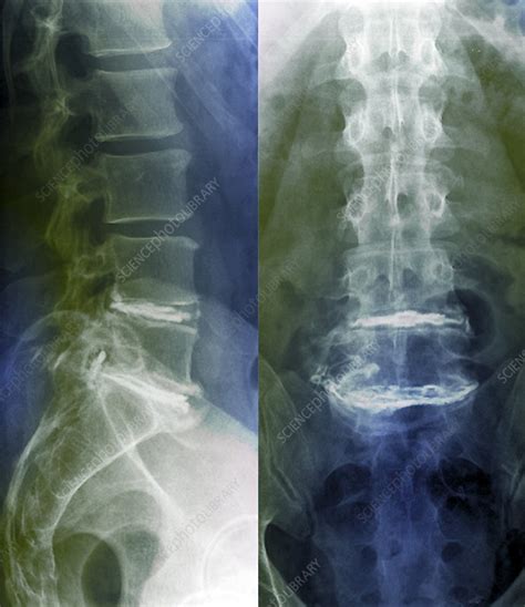 Sciatica X Ray Stock Image C0132206 Science Photo Library