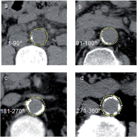 Cross Sectional View Of Abdominal Aortic Calcification By Ct In Four