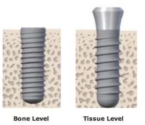 3dcelo Lenfouissement Implantaire Bone Level Vs Tissue Level