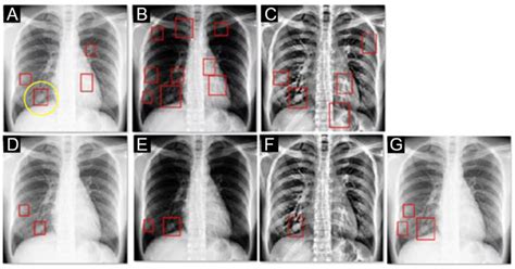 Artificial Intelligence For Early Detection Of Chest Nodules In X Ray Images