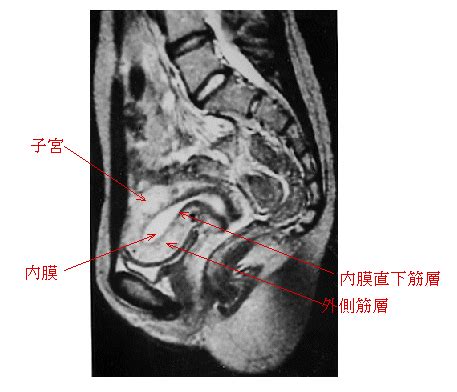 婦人科領域におけるmr診断