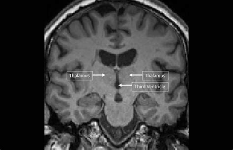Ms Minute Cognitive Dysfunction In People Living With Multi
