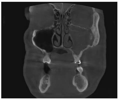 Management Of Odontogenic Sinusitis Results With Single Step Fess And Dentoalveolar Surgery