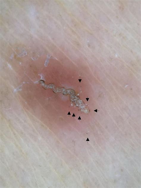 80歲婦染疥瘡 全家淪陷 醫藥百科 健康 世界新聞網