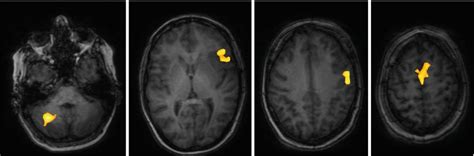 Imaging Modalities And Treatment Of Gliomas Neurosurgery Radiology Key