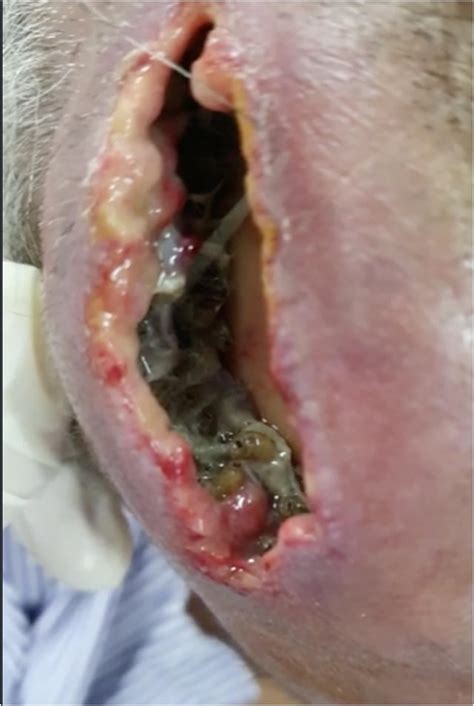 Scalp Myiasis The Patient Was Whacked On The Head By A Falling Tree