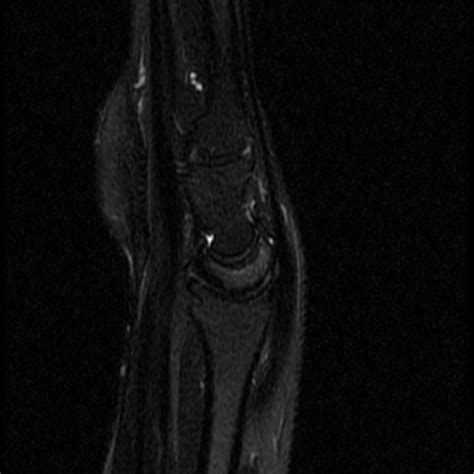 Radiopaedia Case Kienbock Disease Id 17889 Study 17647 Nc Commons