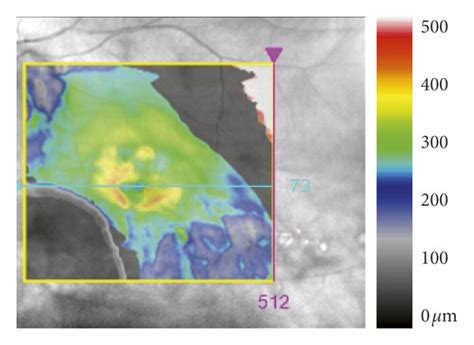 Choroidal Neovascularization In A Patient With Pathological Myopia A Download Scientific