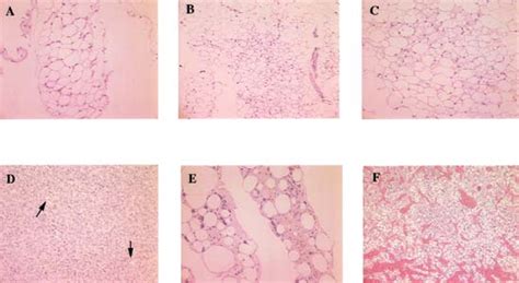 Liposarcoma Development And Wat Abnormalities In Ef Chop Fus Transgenic