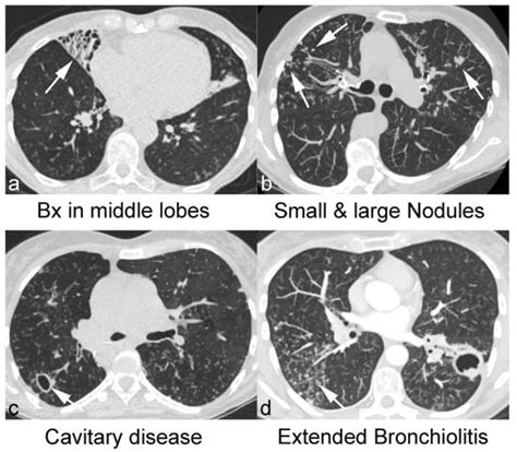 Computed Tomography In Adults With Bronchiectasis And Nontuberculous