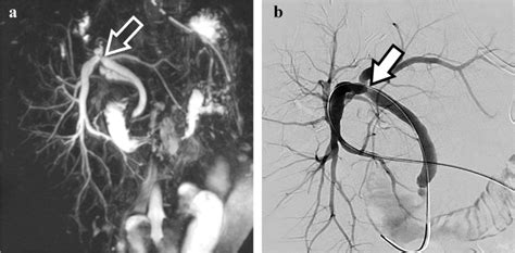 Duct To Duct Anastomotic Stricture In A 9 Month Old Girl At 4 Months
