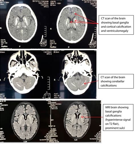 Ct Scan And Brain Mri Of Case 6 Showing Multiple Symmetrical Foci Of Download Scientific
